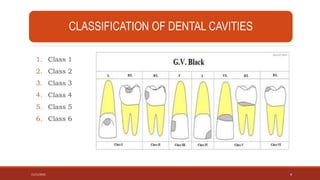 اصول اماده سازی کلاس دوم ، class 2 cavity preparation.pptx