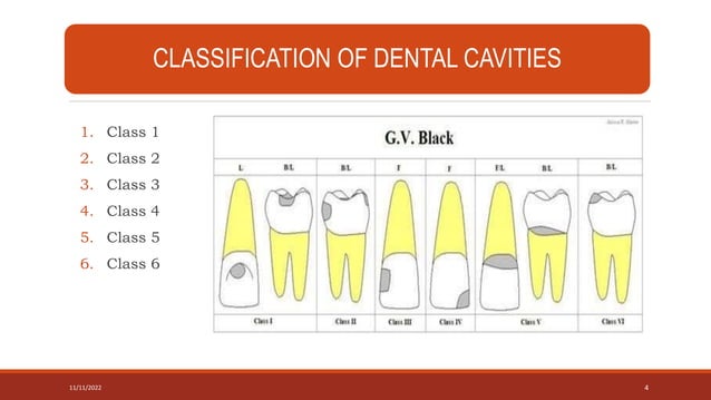 اصول اماده سازی کلاس دوم ، class 2 cavity preparation.pptx