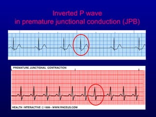Premature Junctional Contraction P Wave
