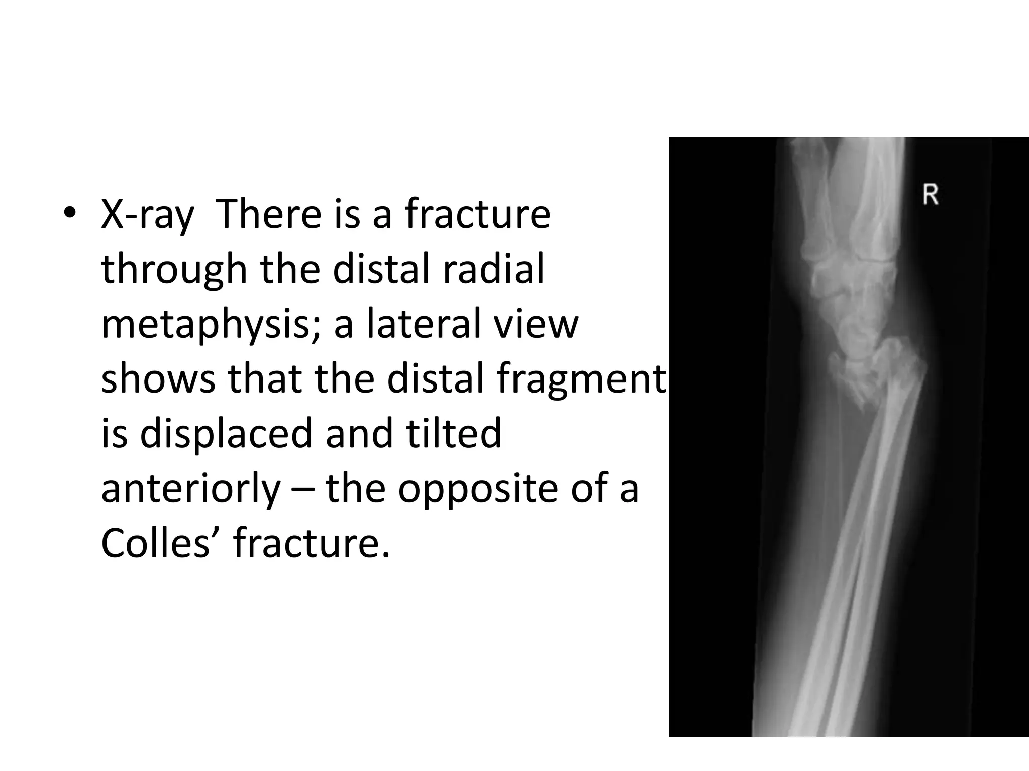 smith fractures | PPTX