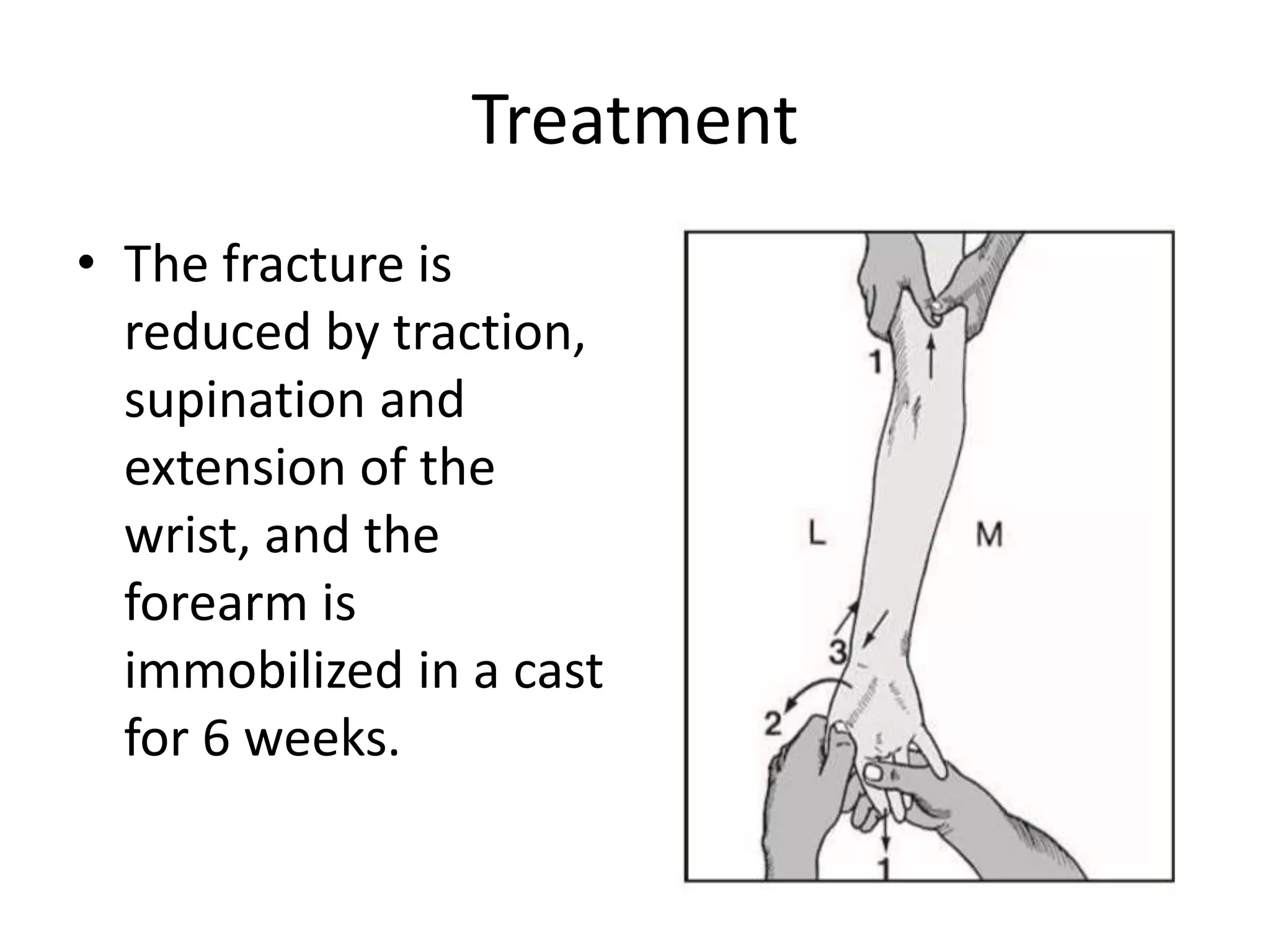smith fractures | PPTX