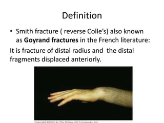 smith fractures | PPTX