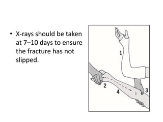 smith fractures | PPTX