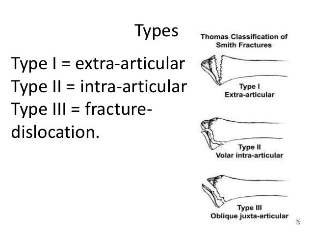 Smith Fracture Radiology