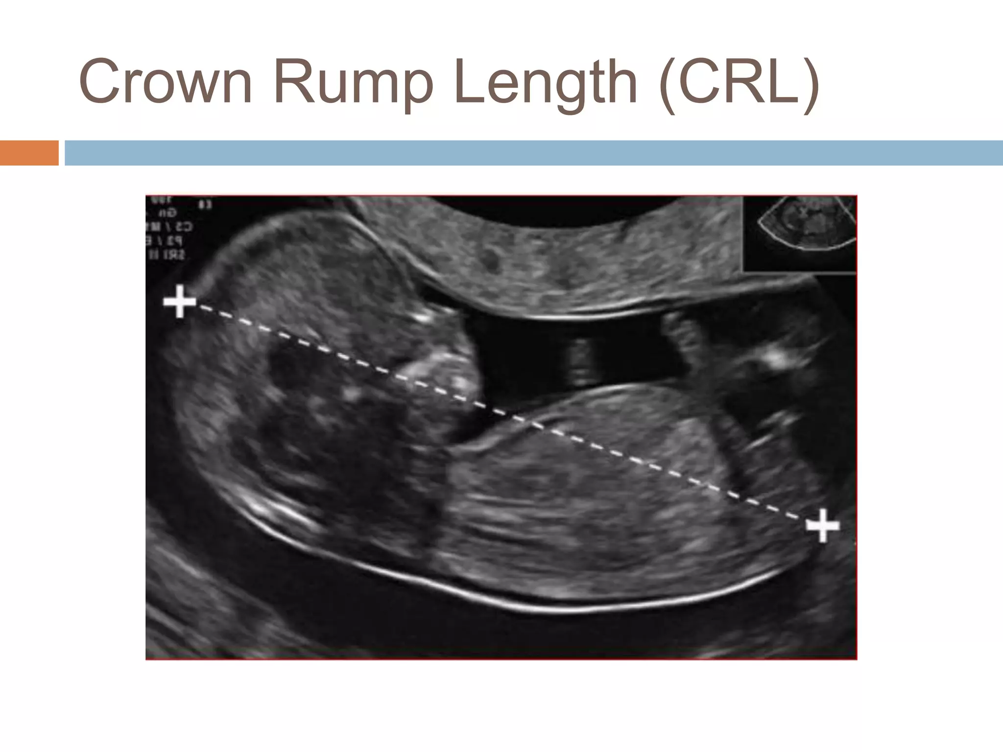 First timester ultrasound. | PPTX