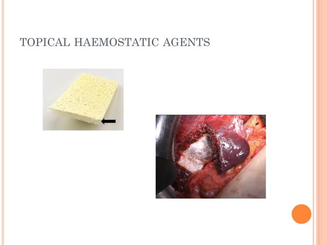1 surgical techniques and topical haemostatic agents in patient | PPT