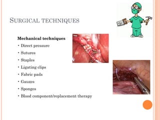 1 surgical techniques and topical haemostatic agents in patient | PDF