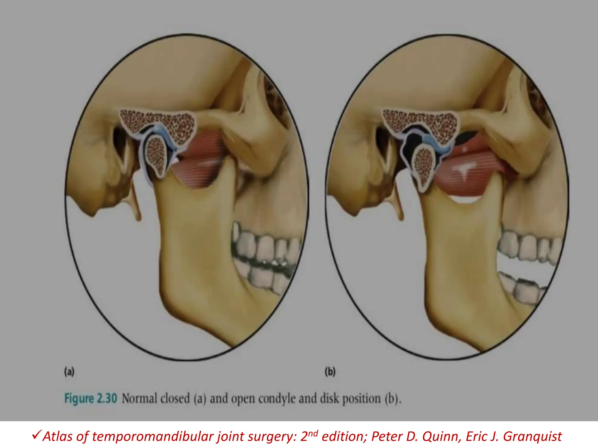 seminar on temporomandibular joint and disorders.pptx