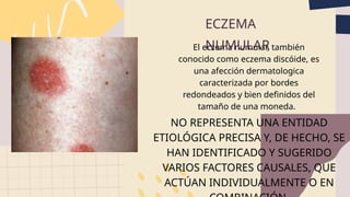 1trabajo eczema numular - reporte de caso.pptx