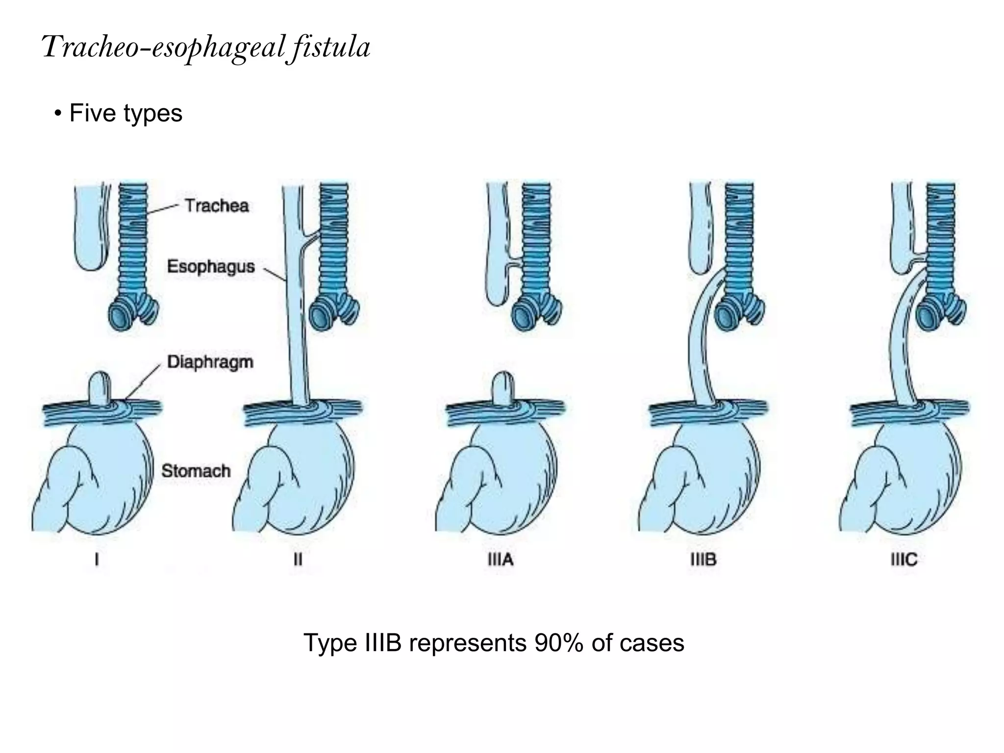 Tracheo Esophageal Fistula and Anesthesia | PPTX