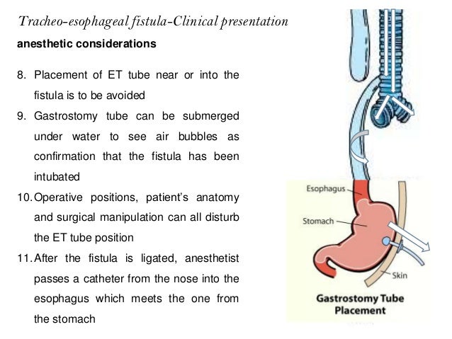 Tracheo Esophageal Fistula and Anesthesia