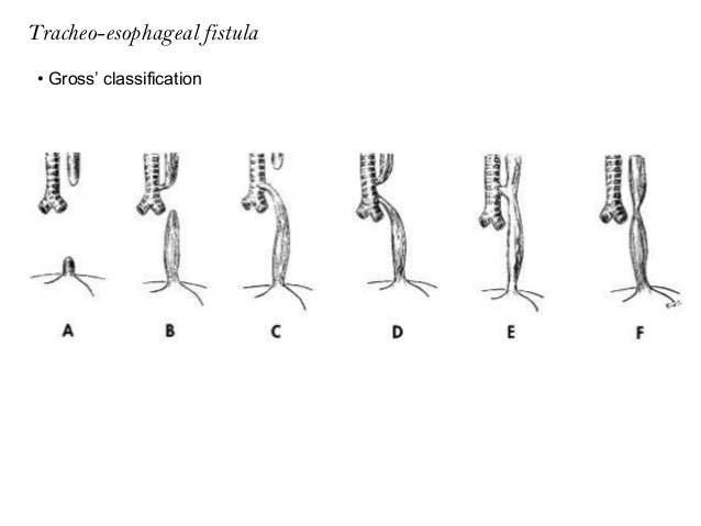 Tracheoesophageal Fistula Classification