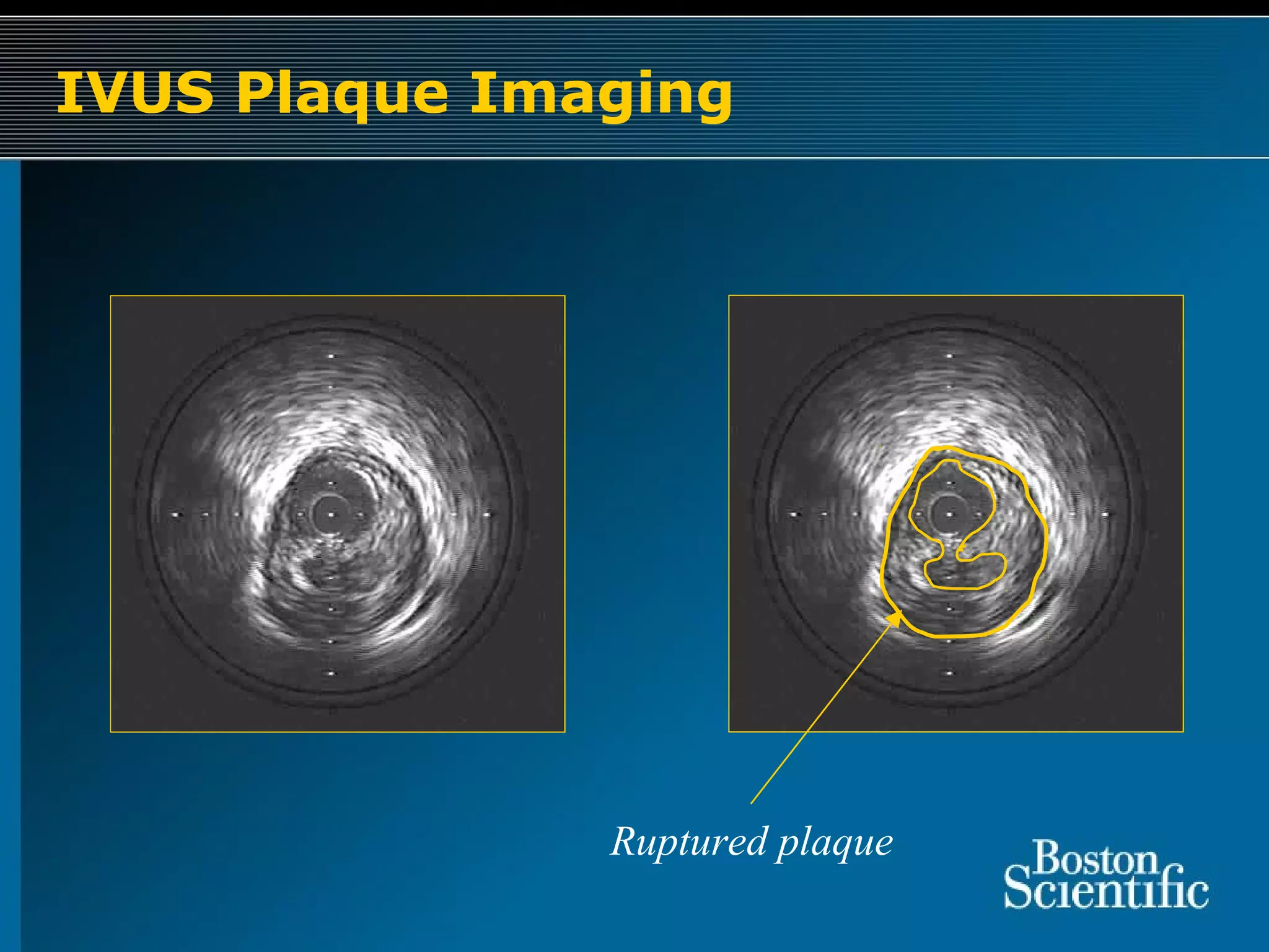 077 intravascular ultrasound for plaque characterization | PPT