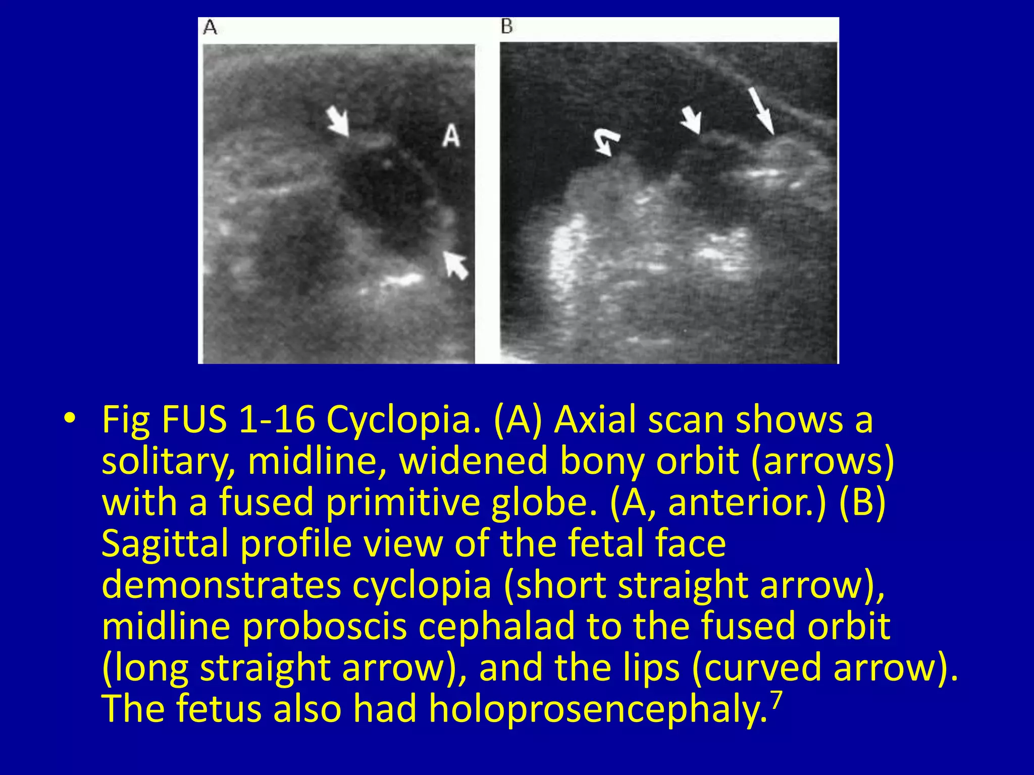 1 ultrasound diagnosis of fetal anomalies | PPTX