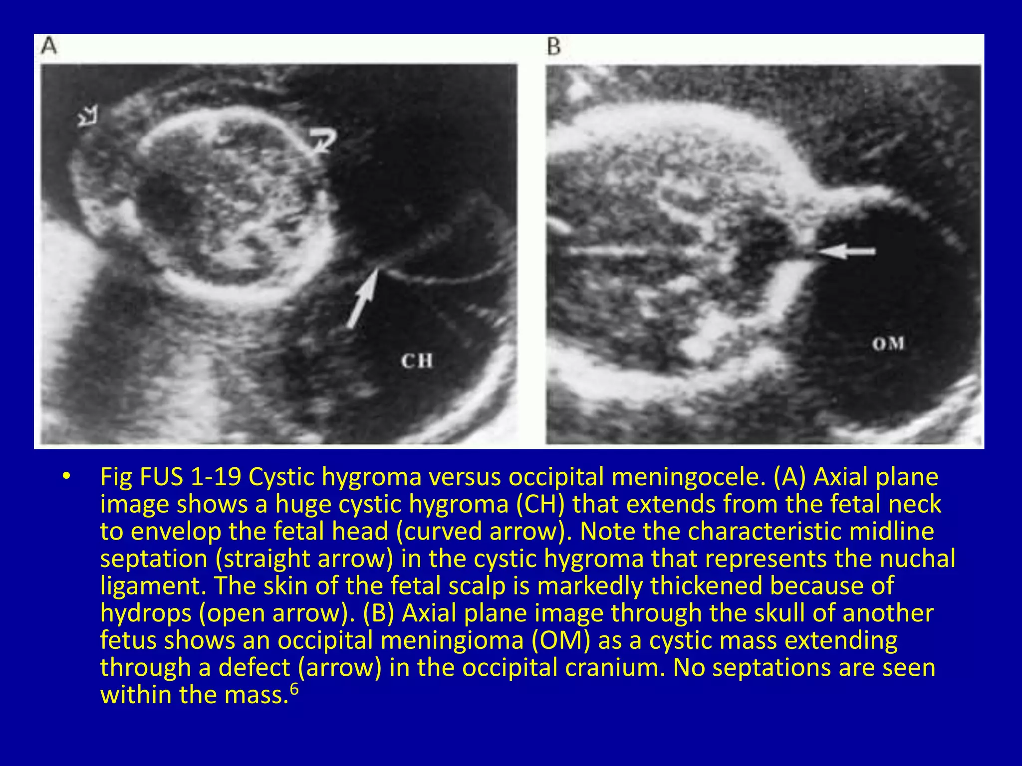 1 ultrasound diagnosis of fetal anomalies | PPTX