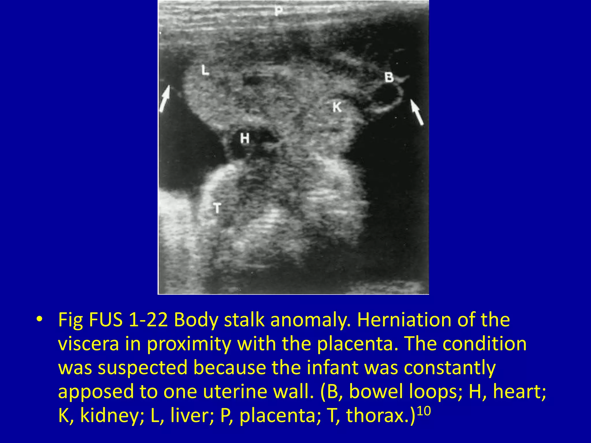 1 ultrasound diagnosis of fetal anomalies | PPTX