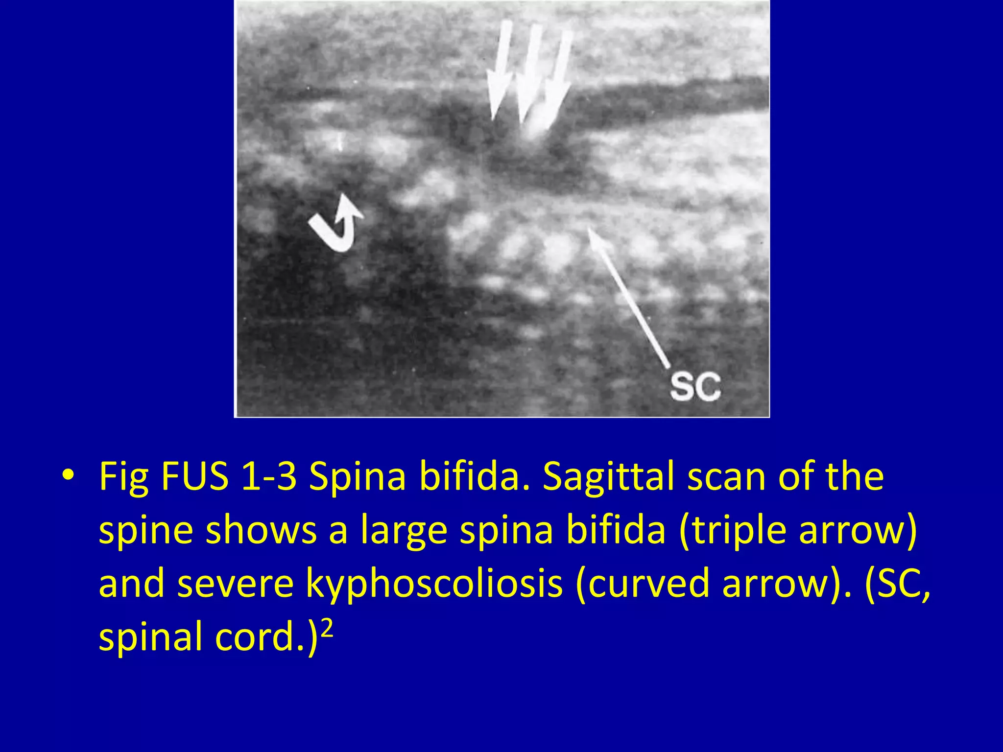 1 ultrasound diagnosis of fetal anomalies | PPTX