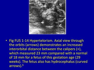 1 ultrasound diagnosis of fetal anomalies | PPTX