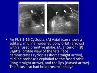 1 ultrasound diagnosis of fetal anomalies | PPTX