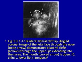 1 ultrasound diagnosis of fetal anomalies | PPTX