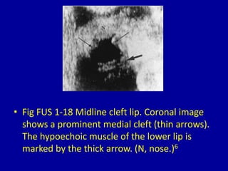 1 ultrasound diagnosis of fetal anomalies | PPTX