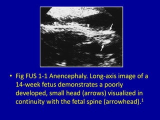 1 ultrasound diagnosis of fetal anomalies | PPTX