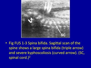 1 ultrasound diagnosis of fetal anomalies | PPTX