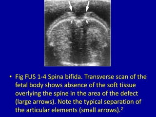 1 ultrasound diagnosis of fetal anomalies | PPTX