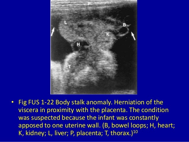 The Anomalies Of Fetus Ultrasound