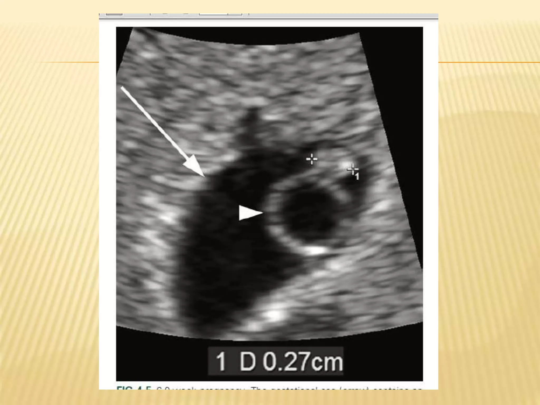 1 ultrasound of the early first trimester | PPTX