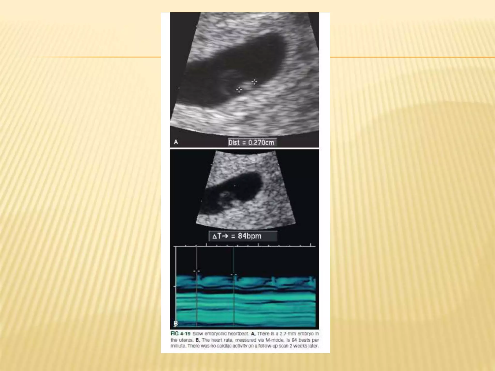 1 ultrasound of the early first trimester | PPTX