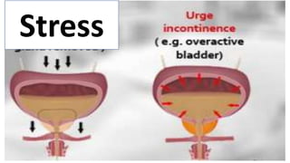 Urinary incontinence at Menopause : Dr Sharda Jain | PPTX