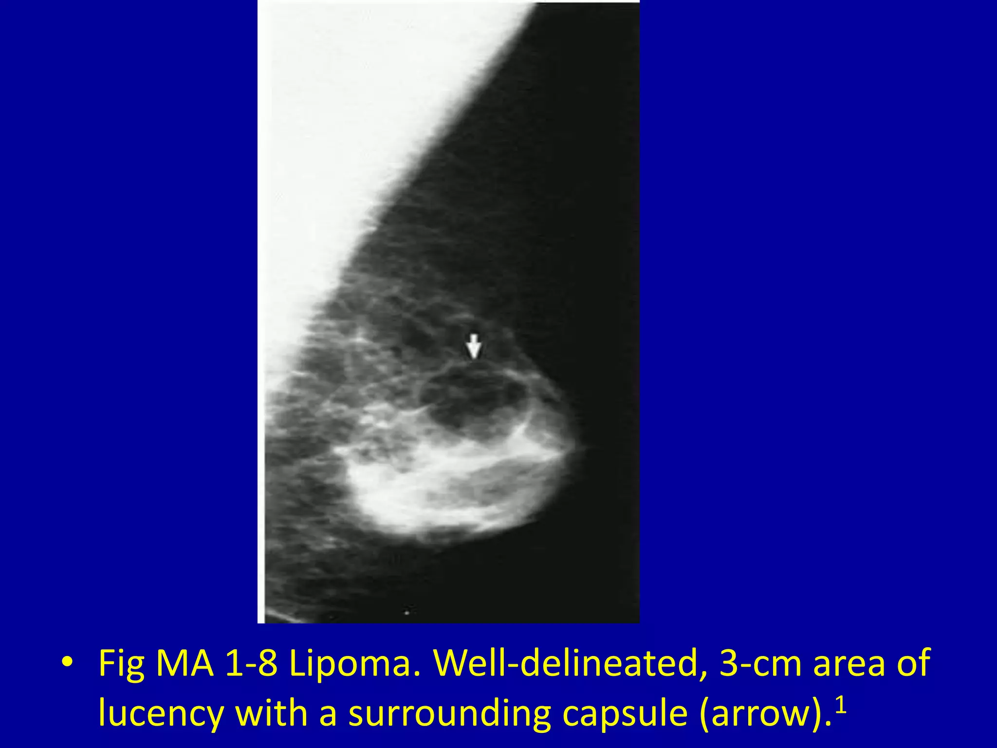 1 well circumscribed breast masses | PPT