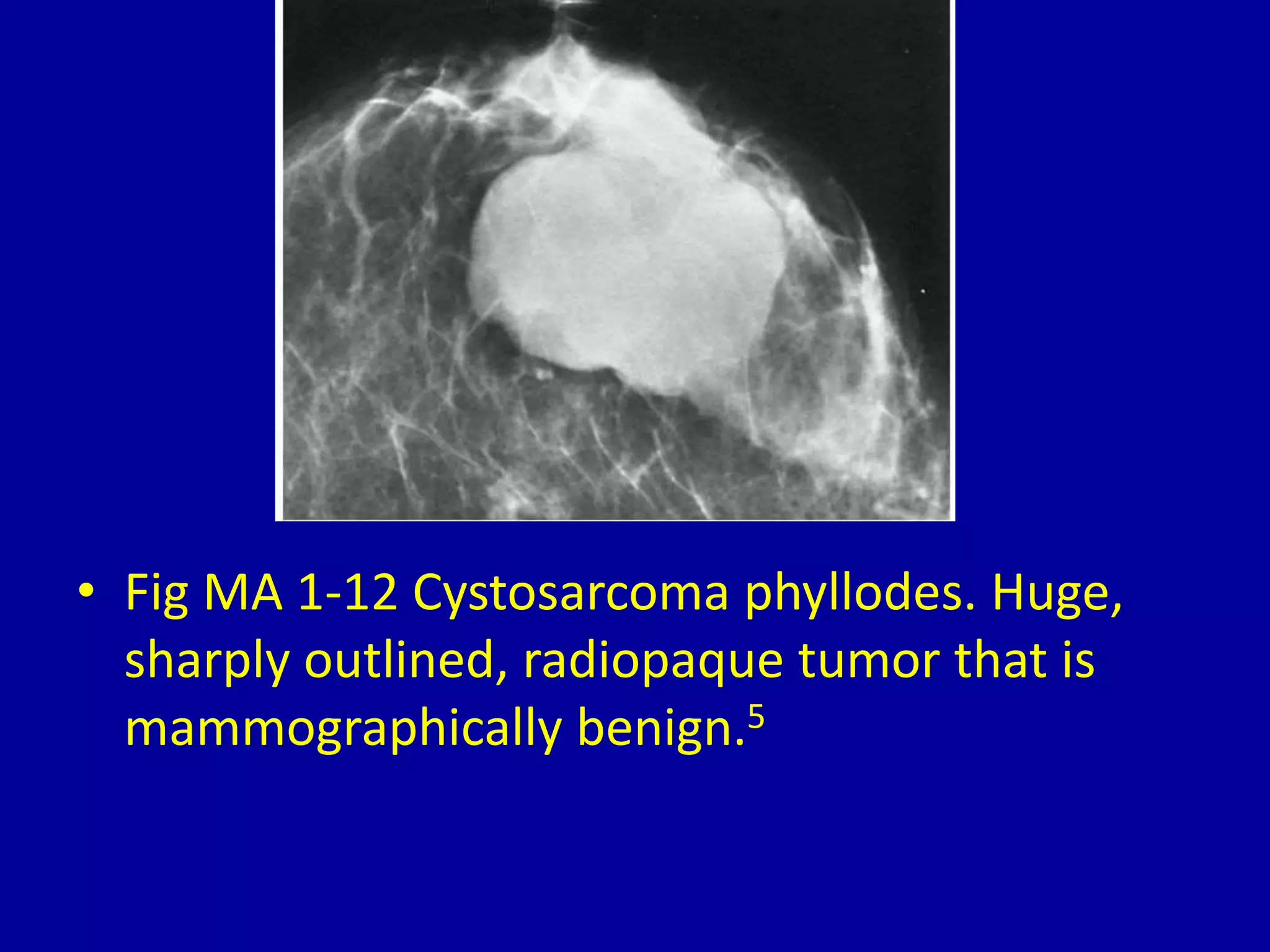 1 well circumscribed breast masses | PPT