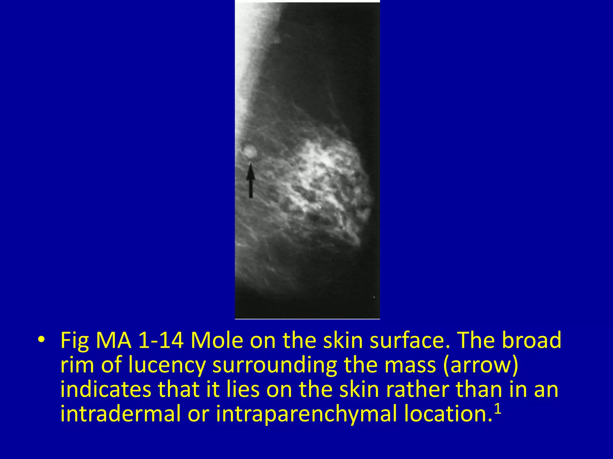 1 well circumscribed breast masses | PPTX