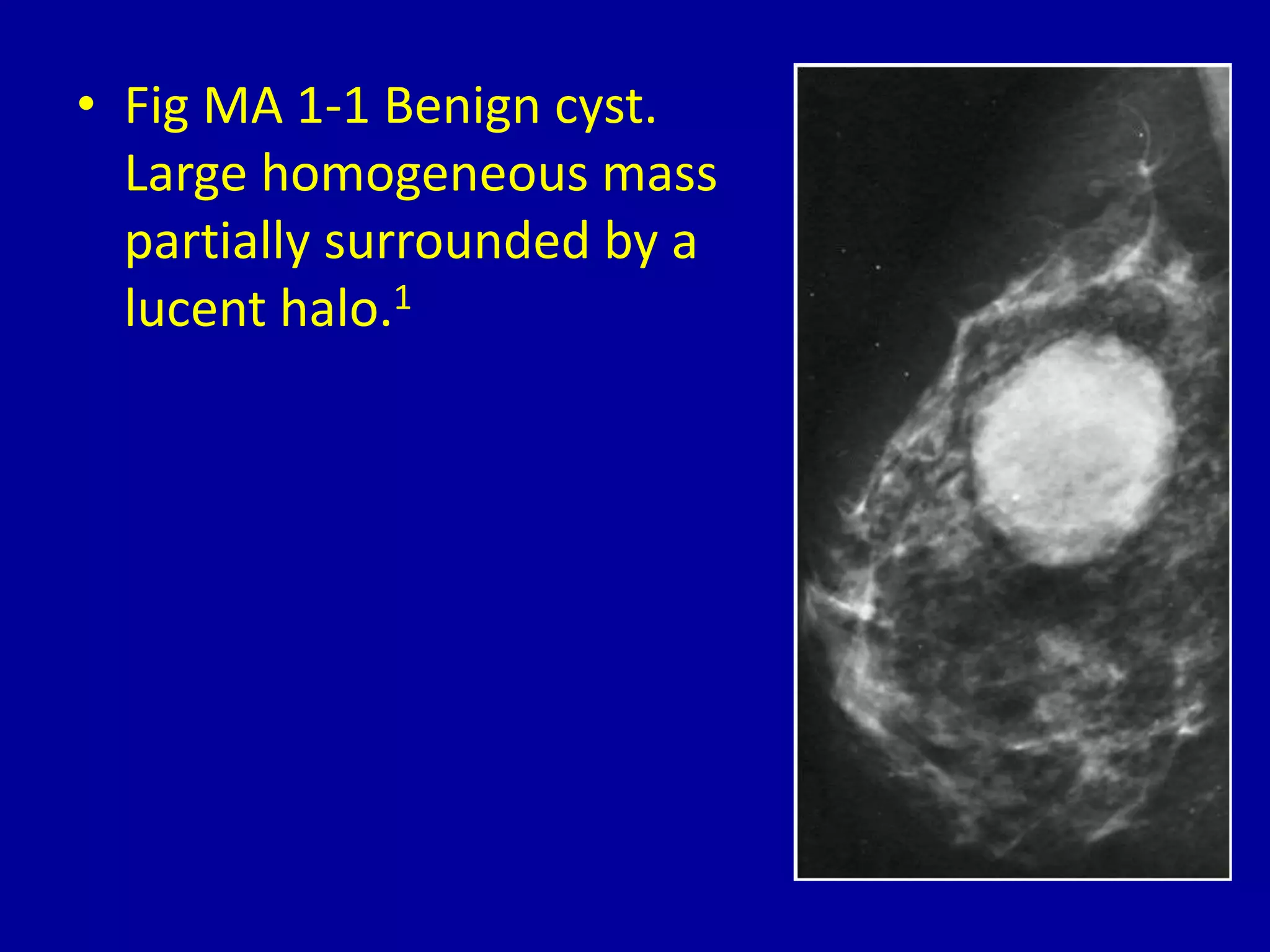 1 well circumscribed breast masses | PPTX