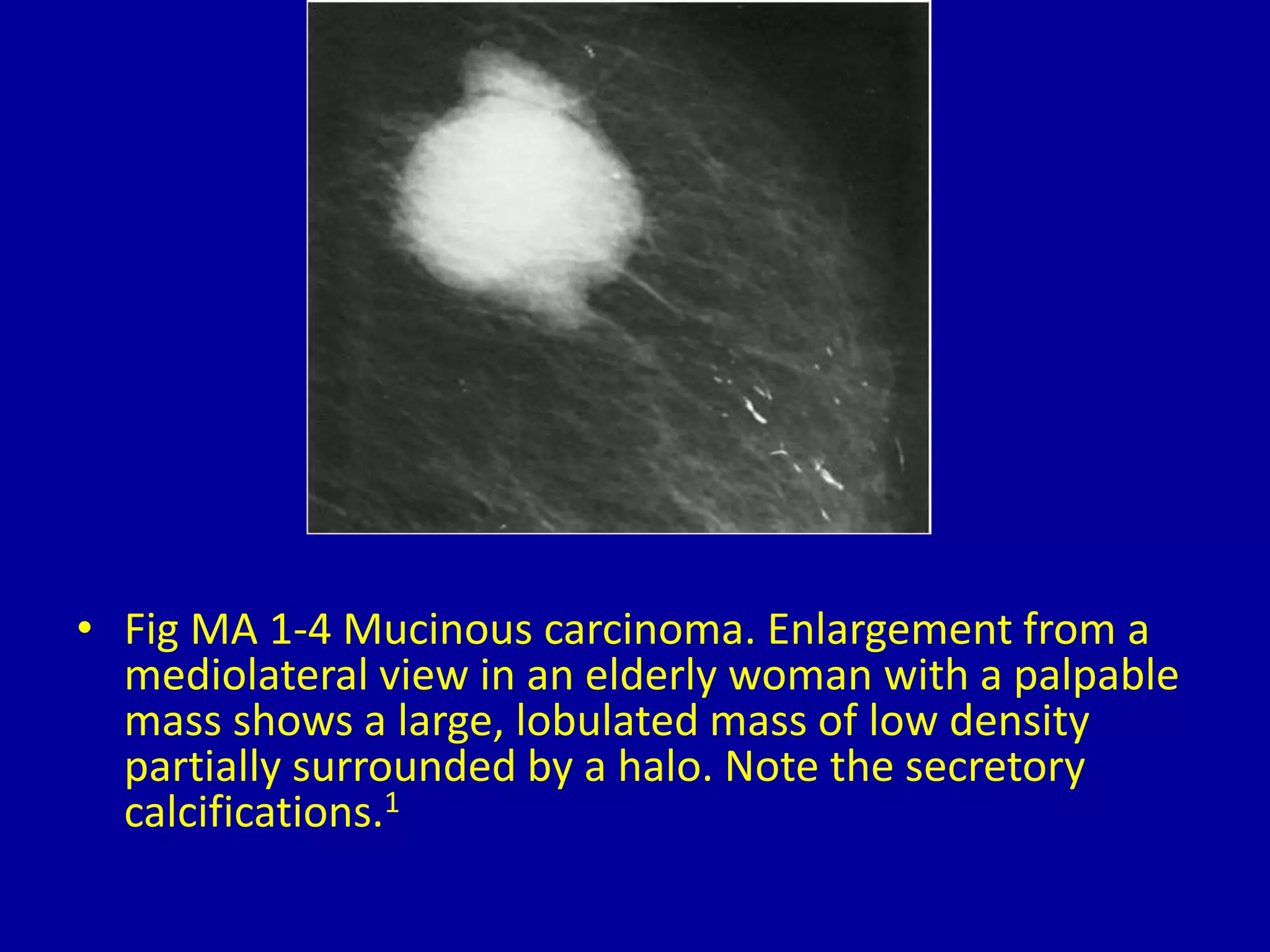 1 well circumscribed breast masses | PPTX