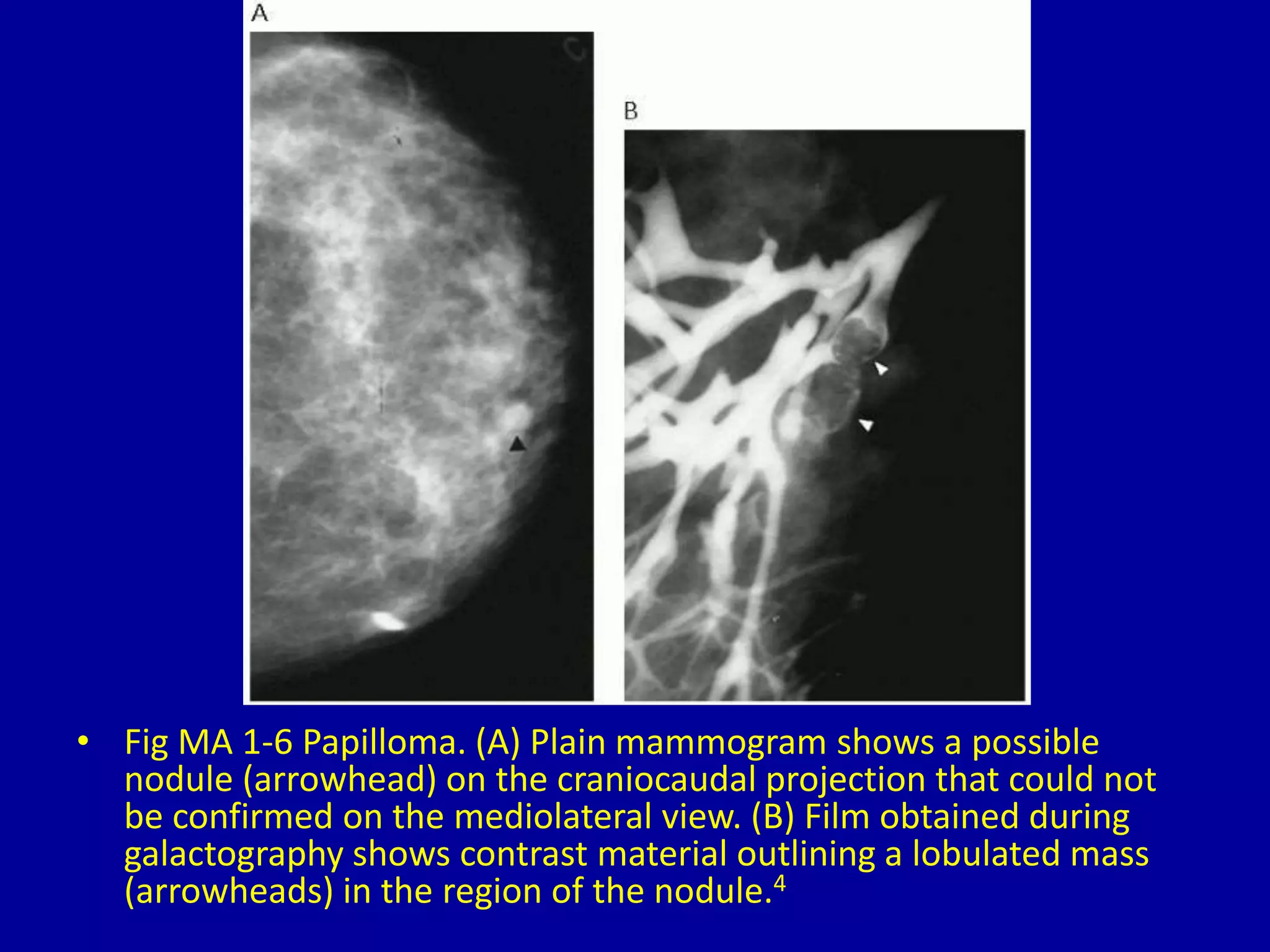 1 well circumscribed breast masses | PPTX