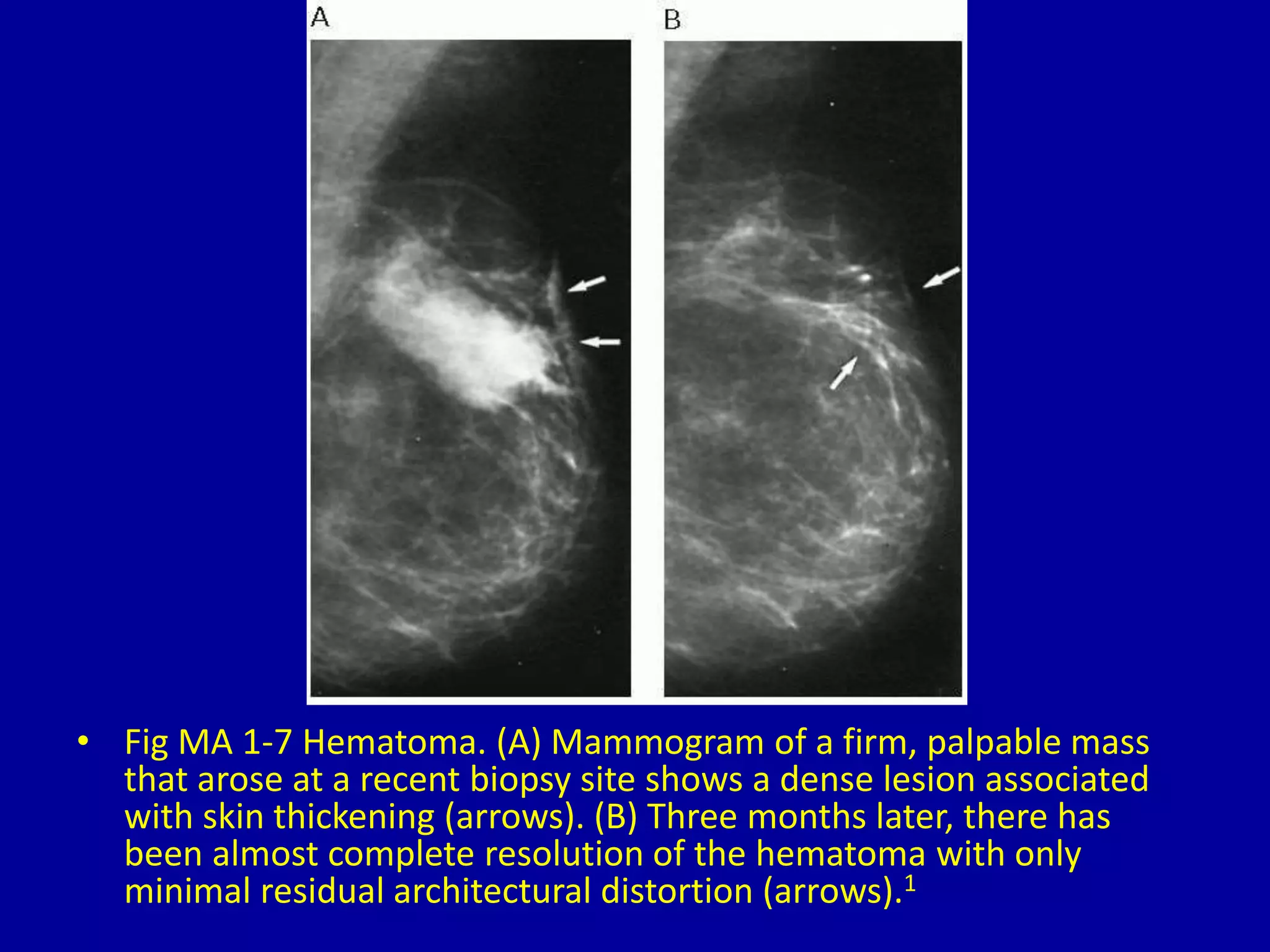 1 well circumscribed breast masses | PPTX