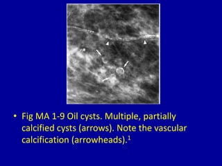 1 well circumscribed breast masses | PPTX