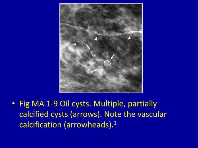 1 well circumscribed breast masses | PPT