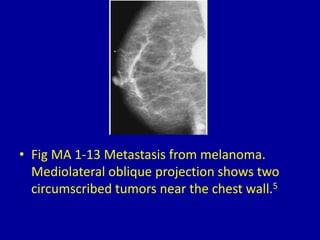 1 well circumscribed breast masses | PPTX