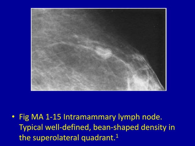 1 well circumscribed breast masses | PPT