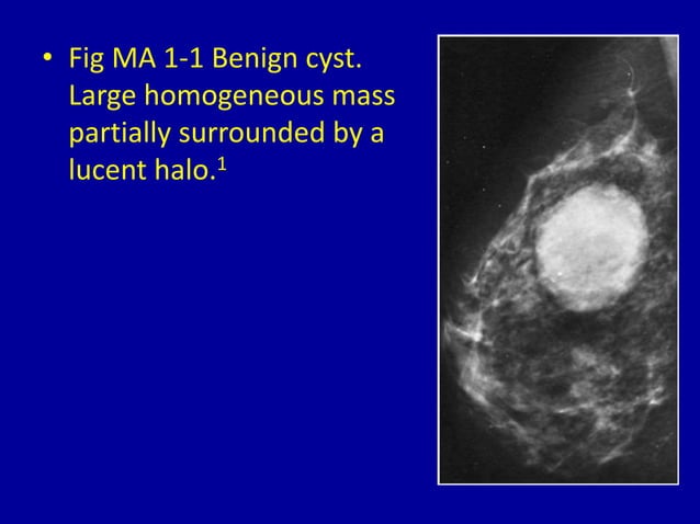 1 well circumscribed breast masses | PPT