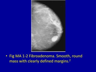 1 well circumscribed breast masses | PPTX