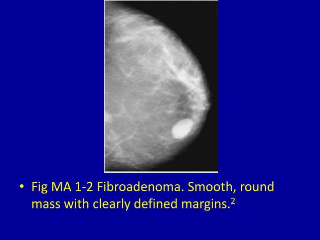 1 well circumscribed breast masses | PPT