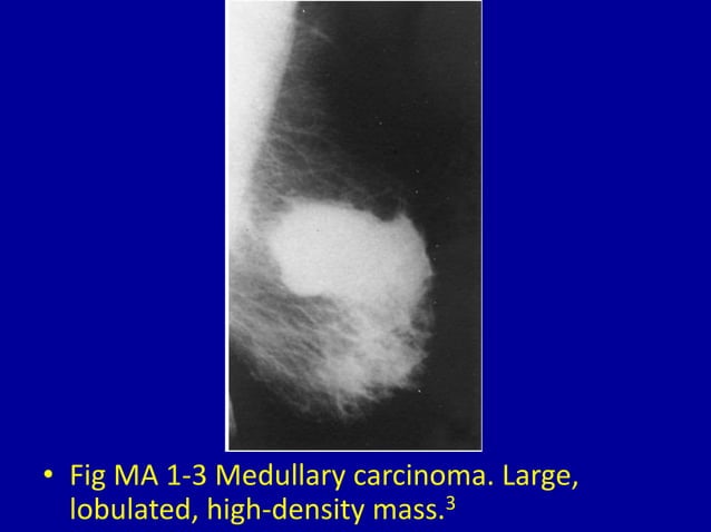 1 well circumscribed breast masses | PPT