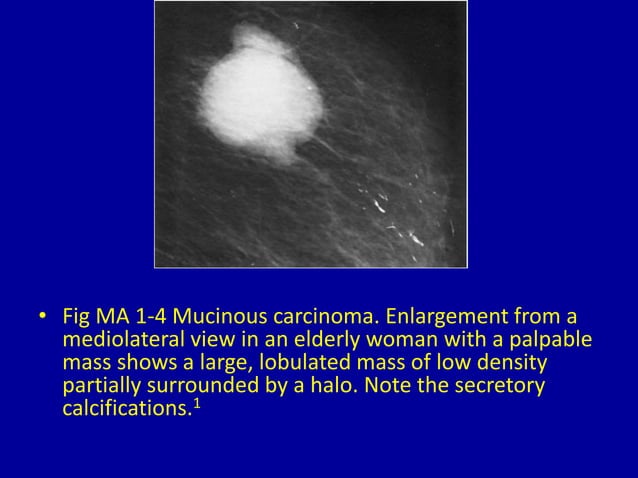 1 well circumscribed breast masses | PPT