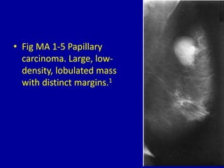 1 well circumscribed breast masses | PPTX