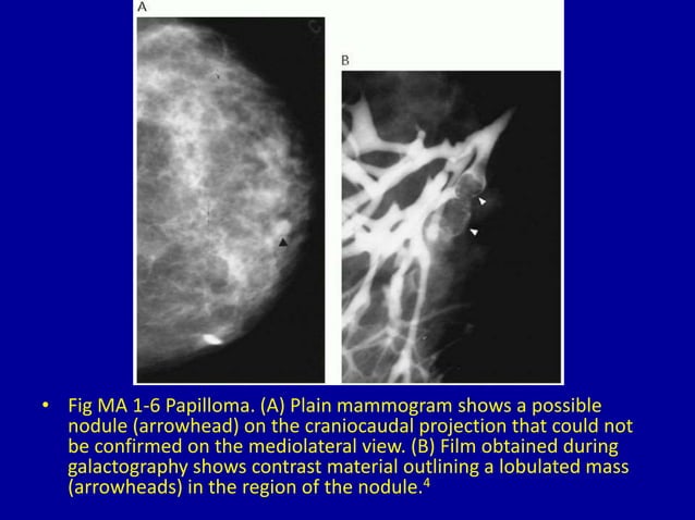 1 well circumscribed breast masses | PPT